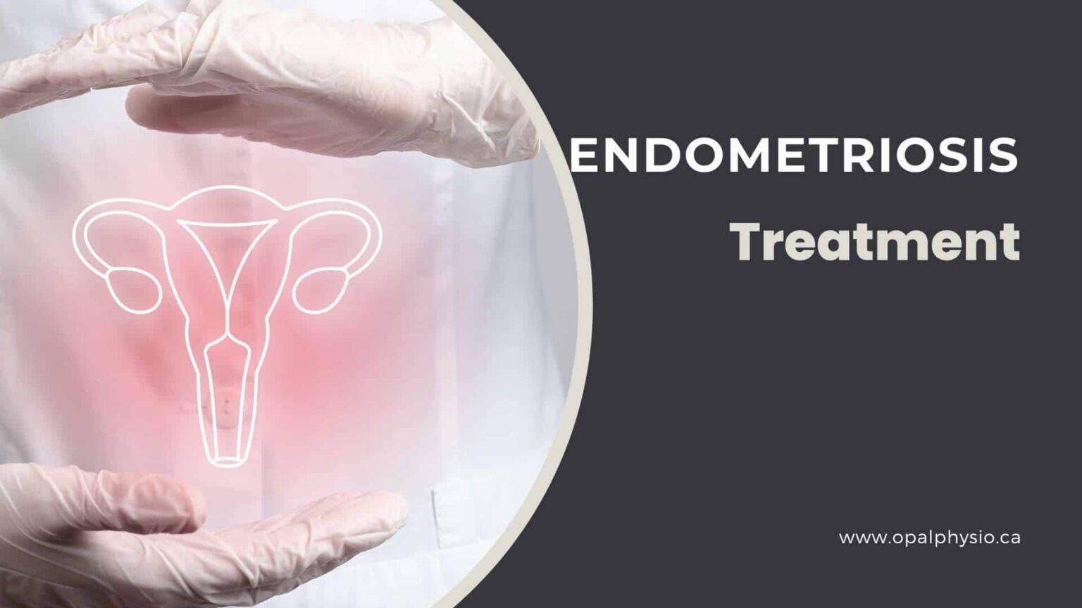 Endometriosis Physiotherapy Treatment In Langley