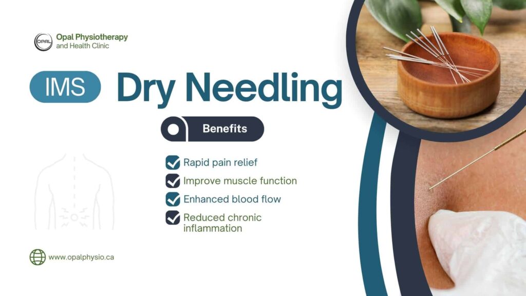 Dry Needling | Intramuscular Stimulation| IMS | Langley, BC