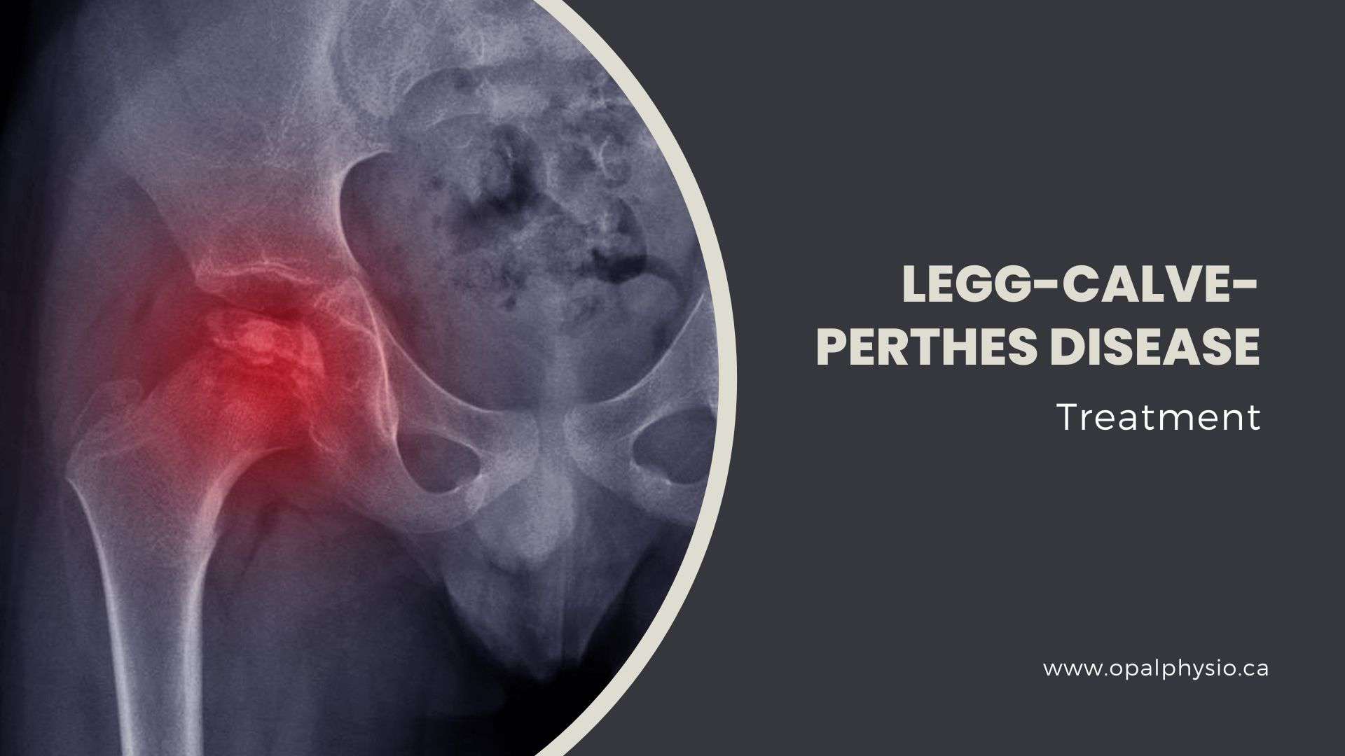 Legg Calve Perthes Disease