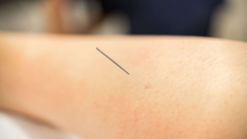 Dry Needling | Intramuscular Stimulation| IMS | Langley, BC