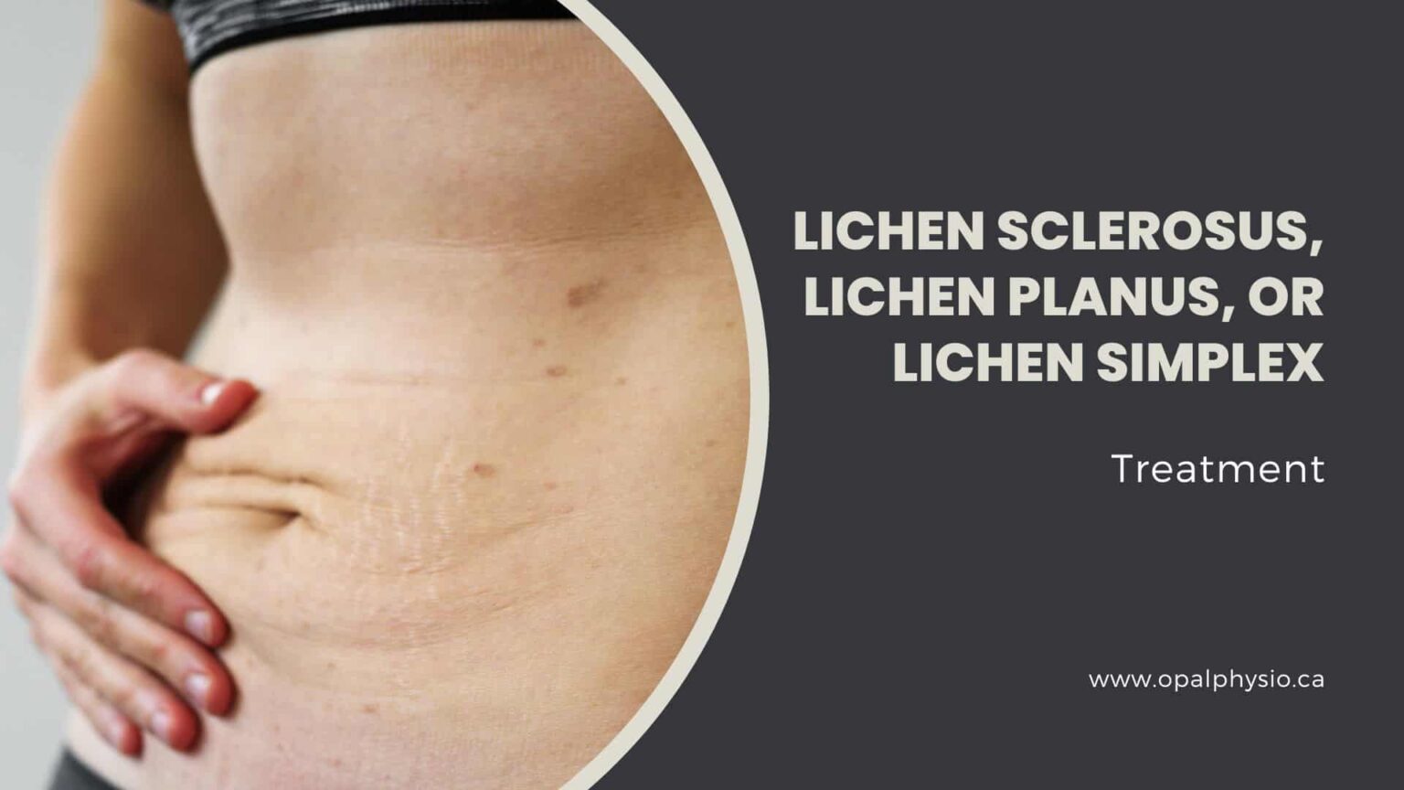 Lichen Sclerosus, Simplex And Planus Condition Physiotherapy Treatment