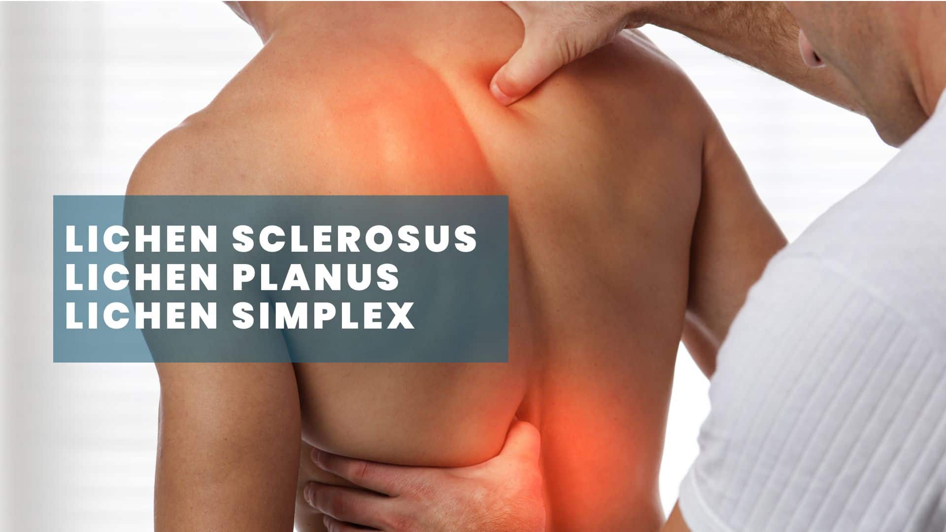 Lichen Sclerosus, Simplex And Planus Condition Physiotherapy Treatment
